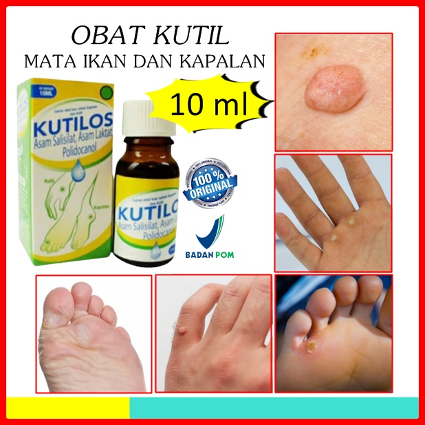 Jual Obat mata ikan di jari jari tangan kaki leher terampuh BPOM ...