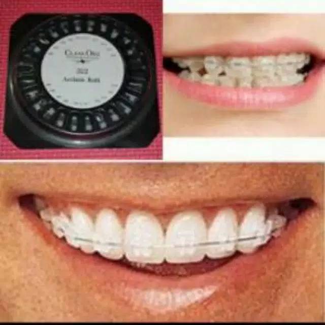 Jual BRACKET CLASSONE KERAMIK transparan bening behel gigi kawat ...