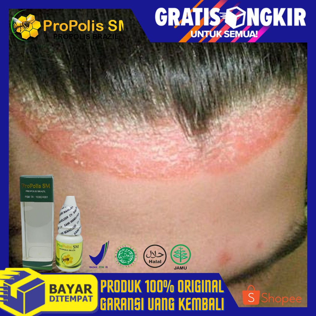 Jual Obat Psoriasis Kulit Kepala, Kulit Kepala Bersisik, Kering, Menebal, Gatal - Propolis SM ...