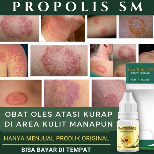 Jual Obat Oles Kurap Jamur Kulit Bercak Merah Gatal Gatel Parah Ruam ...