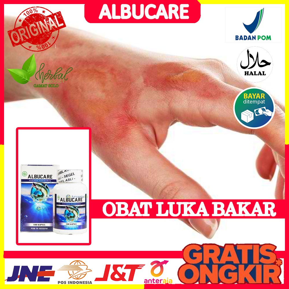 Jual Obat Luka Bakar di Kaki dan di Tangan, Luka Bakar Melepuh, Luka ...