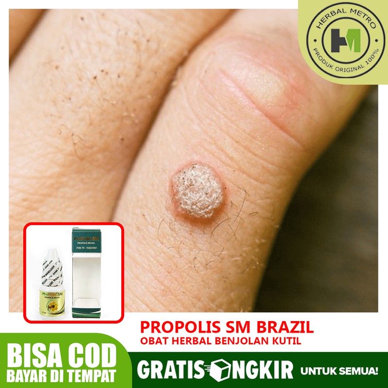 Jual Obat Benjolan Kutil - Kutil Di Badan - Penghilang Kutil Propolis ...
