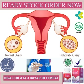 Jual Obat Pcos, Obat Untuk Pcos, Obat Sindrom Ovarium Polikistik, Obat ...