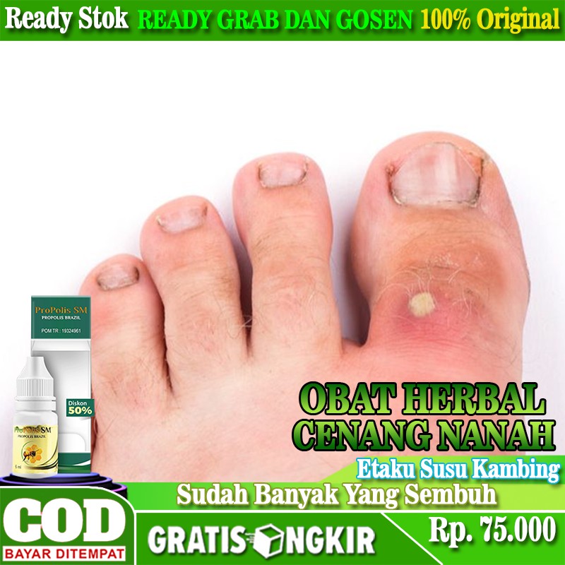 Jual Obat Cenang Nanah, Obat Budug Bernanah, Bisul, Obat Luka Koreng ...