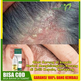 Jual Obat Koreng di kepala | Herbal Menghilangkan Koreng di Kulit Kepala, Keropeng, Obat ...