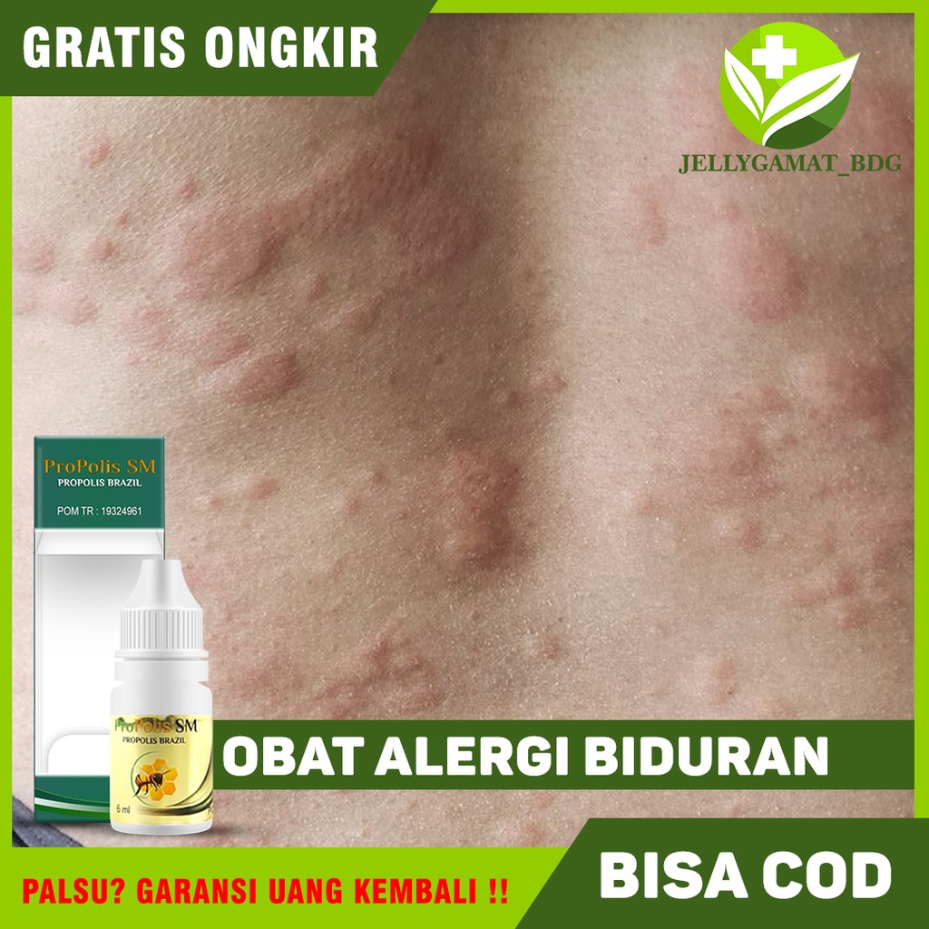 Jual Obat Biduran, Gatal Gatal, Timbul Benjolan Berwarna Merah Propolis ...