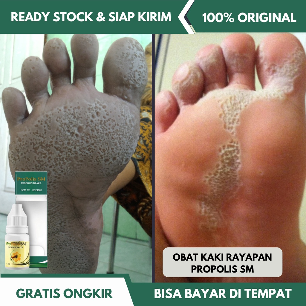 Jual Obat Kaki Bolong-Bolong, Telapak Kaki Rayapan, Rorombeheun, Obat ...