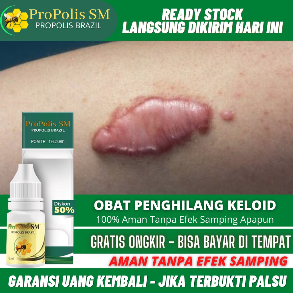Jual Obat Penghilang Keloid, Obat Keloid Menonjol Tahunan, Obat Keloid ...