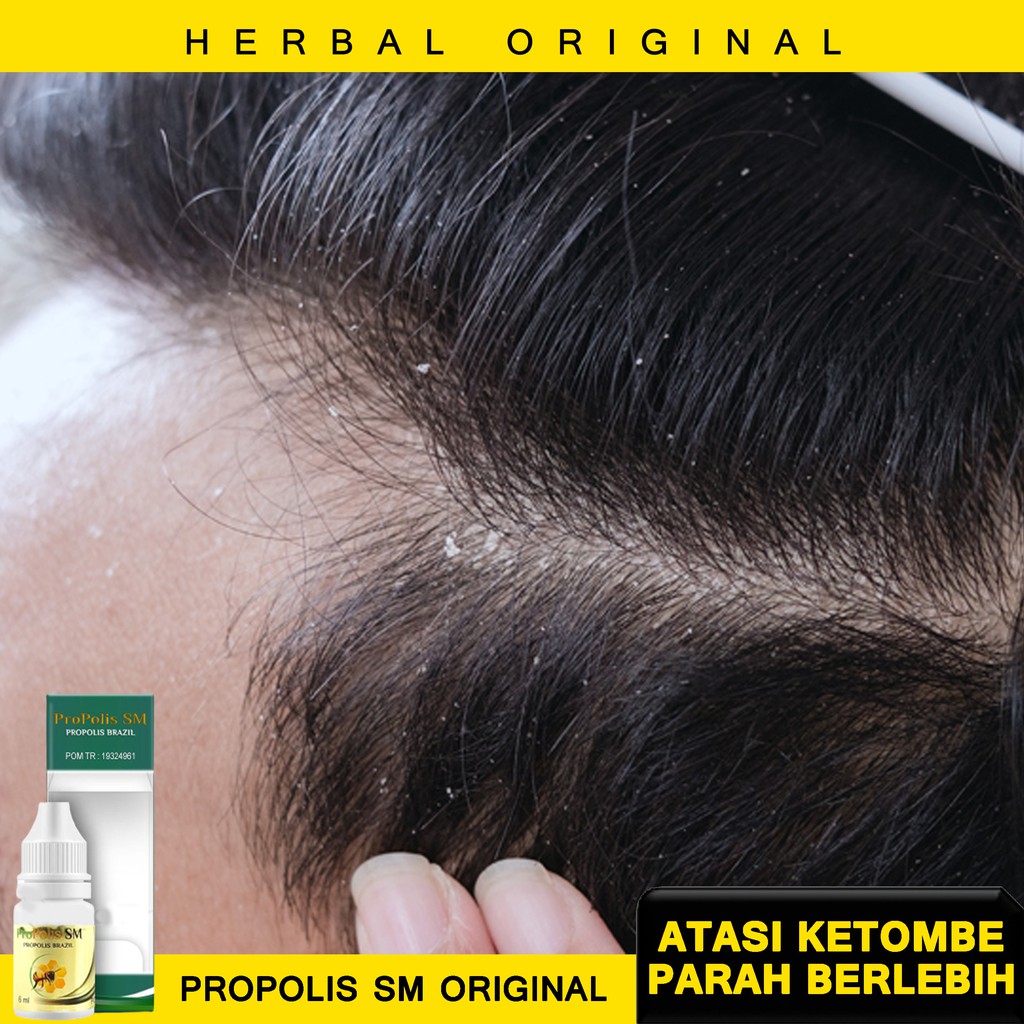 Jual Obat Kerak Ketombe - Obat Ketombe Propolis SM ASLI - Obat Hilangkan Ketombe - Perawatan ...
