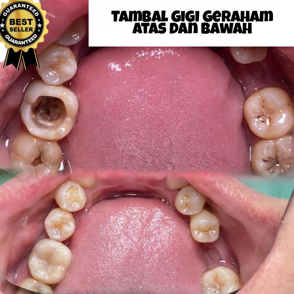 Jual Fitur utama SANGAT KUAT!! Penambal Gigi Berlubang 100% ORIGINAL ASLI Temptooth Temporary ...