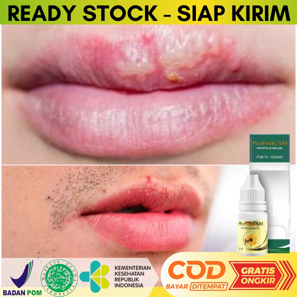 Jual [COD] Obat Tetes Oles Penghilang Bintik Putih di Bibir, Fordyce ...