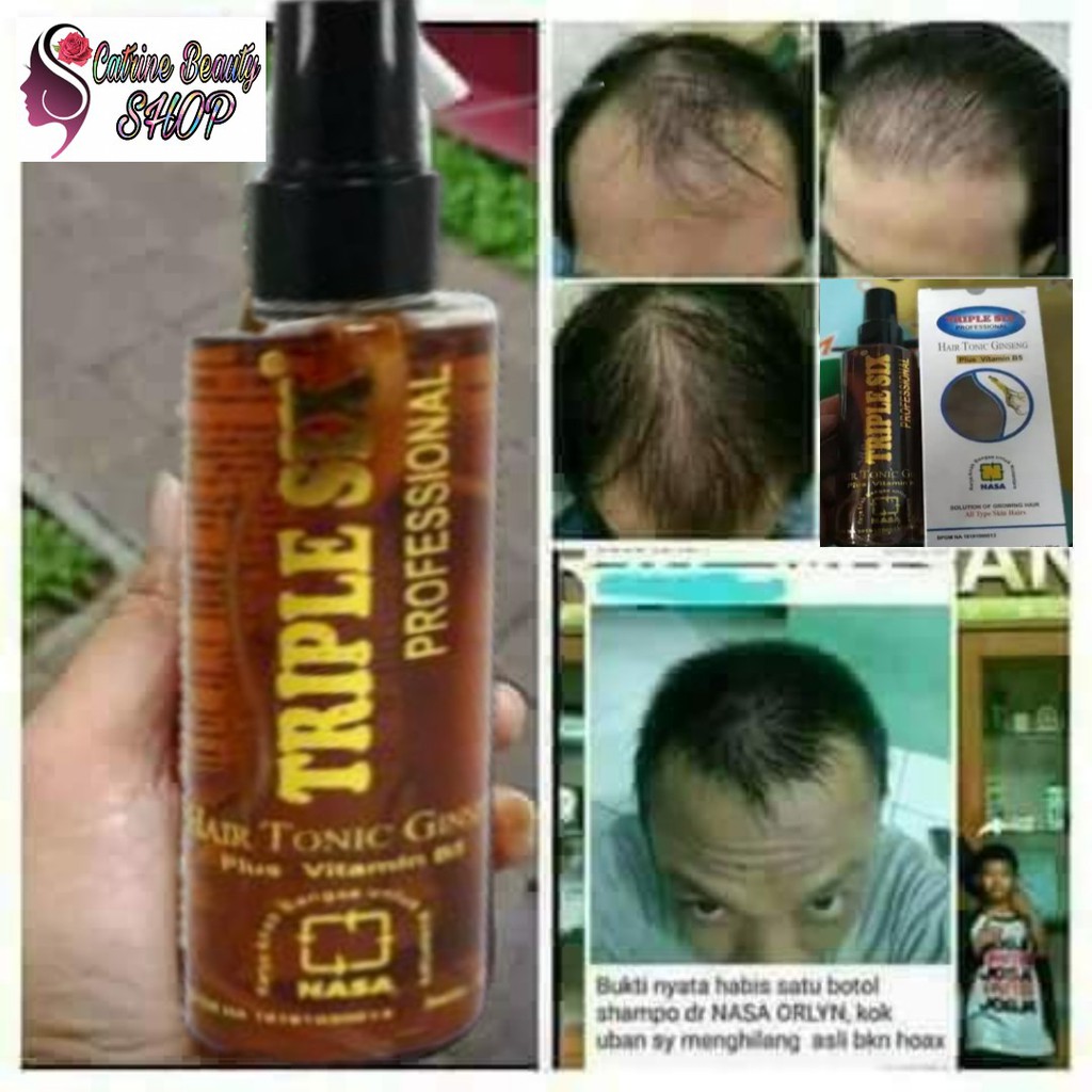 Jual MENGATASI RAMBUT RONTOK PARAH - SOLUSI KEBOTAKAN - PENUMBUH RAMBUT ...