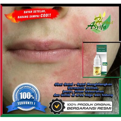 Jual Obat Gatal - Gatel Menghilangkan Dermatitis kontak, jamur, Infeksi ...