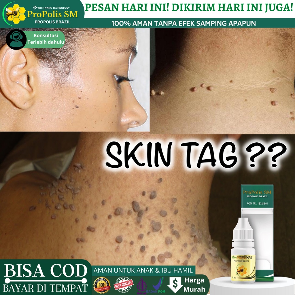 Jual Obat/Salep Daging Tumbuh Daging Jadi Di Wajah Di Leher, Obat ...