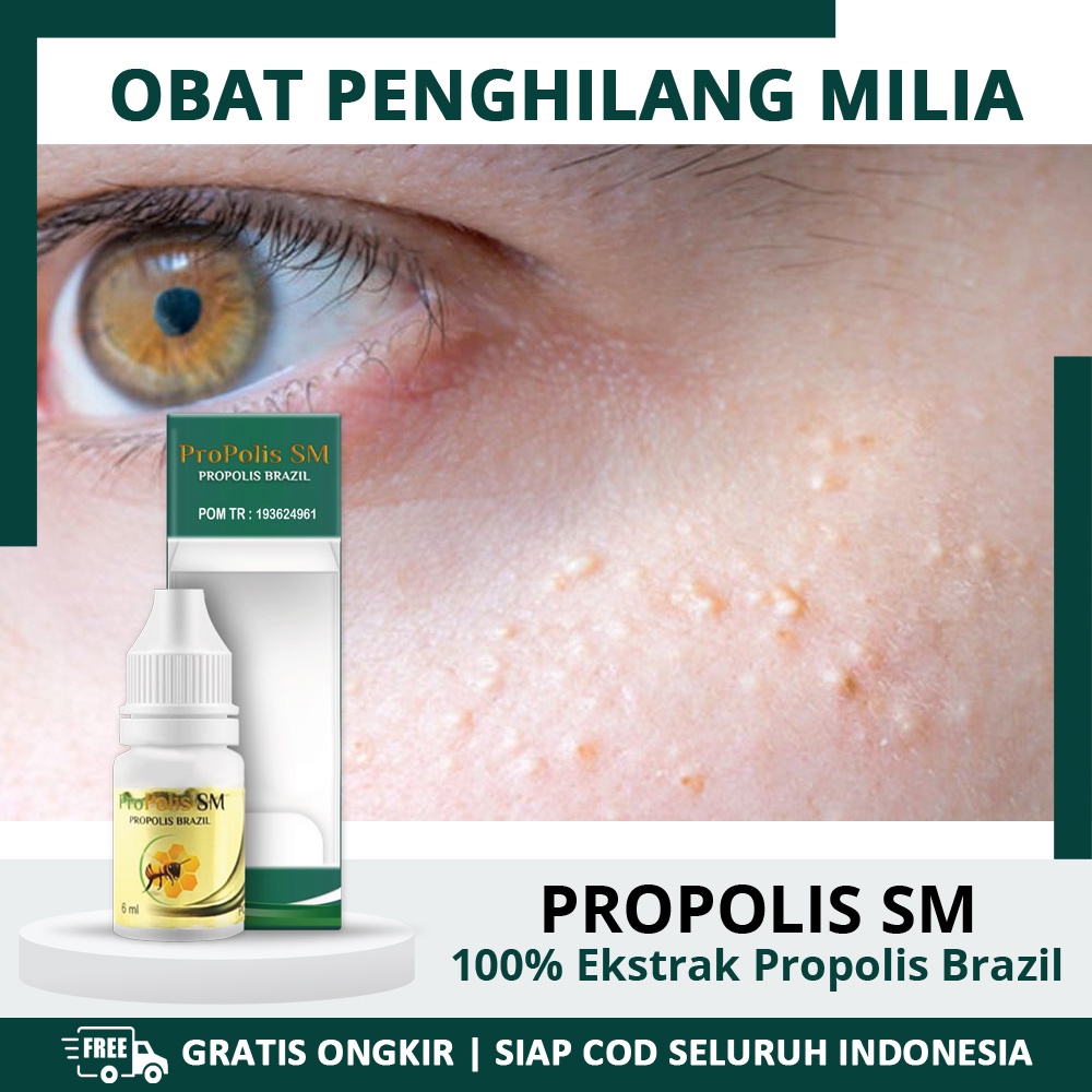 Jual Obat Alami Milia Bintik Putih Kecil Bintil Di Wajah Pipi Kelopak ...