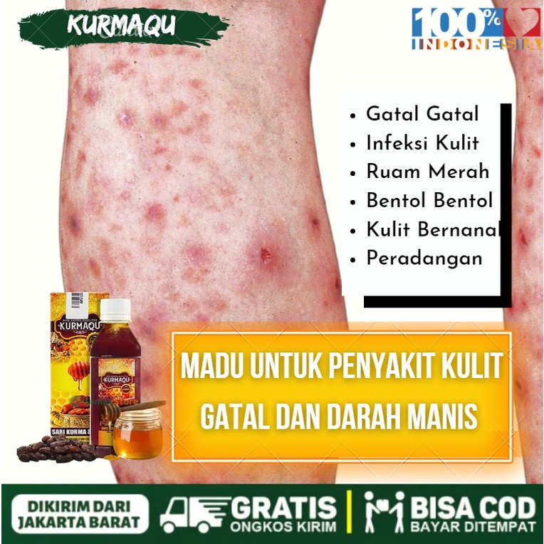 Jual MADU ATASI PENYAKIT KULIT DARAH MANIS, OBAT MINUM GATAL GATAL PADA ...