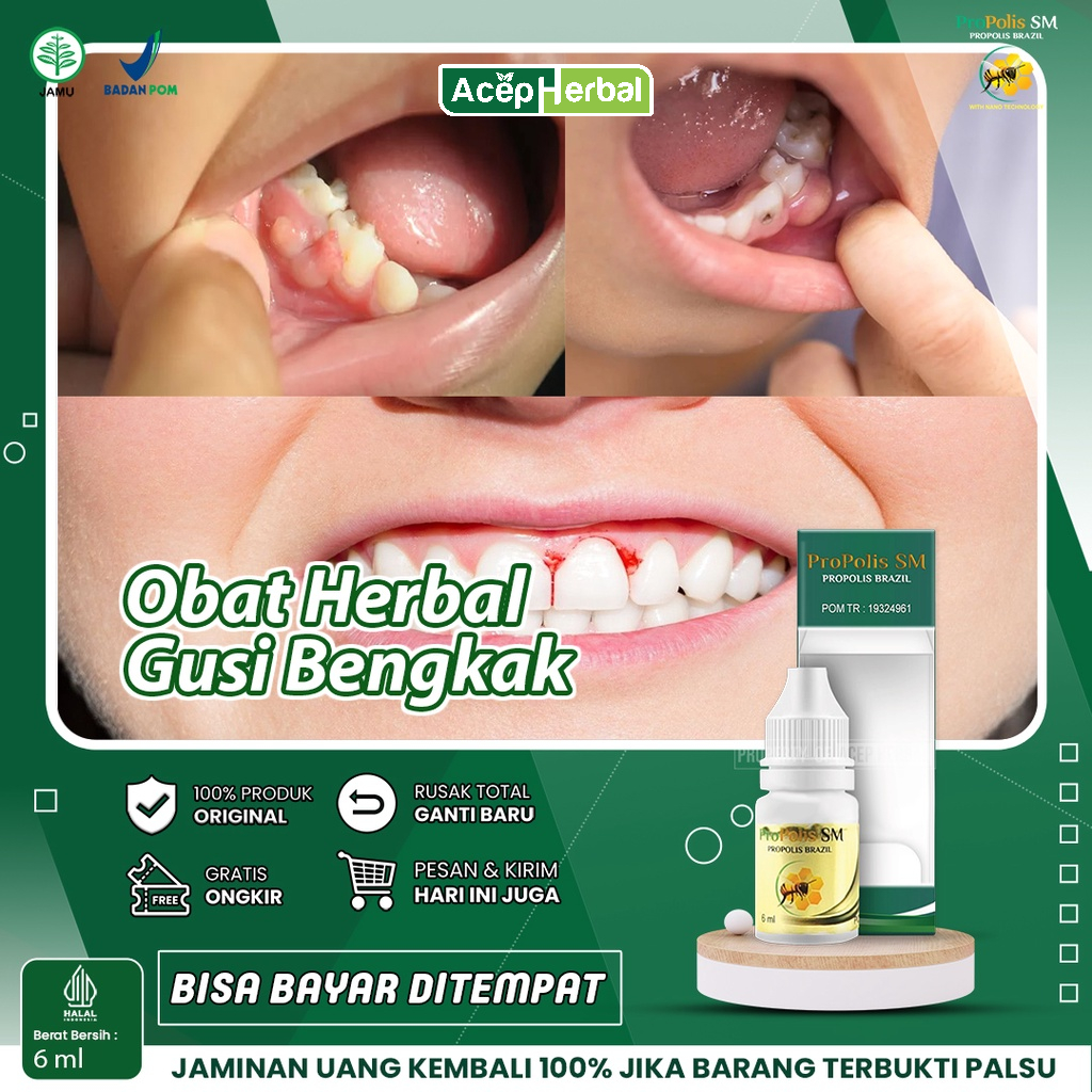 Jual Obat Gusi Bengkak Gusi Berdarah Gigi Berlubang Abses Gigi Gusi Bernanah Sariawan - Propolis ...