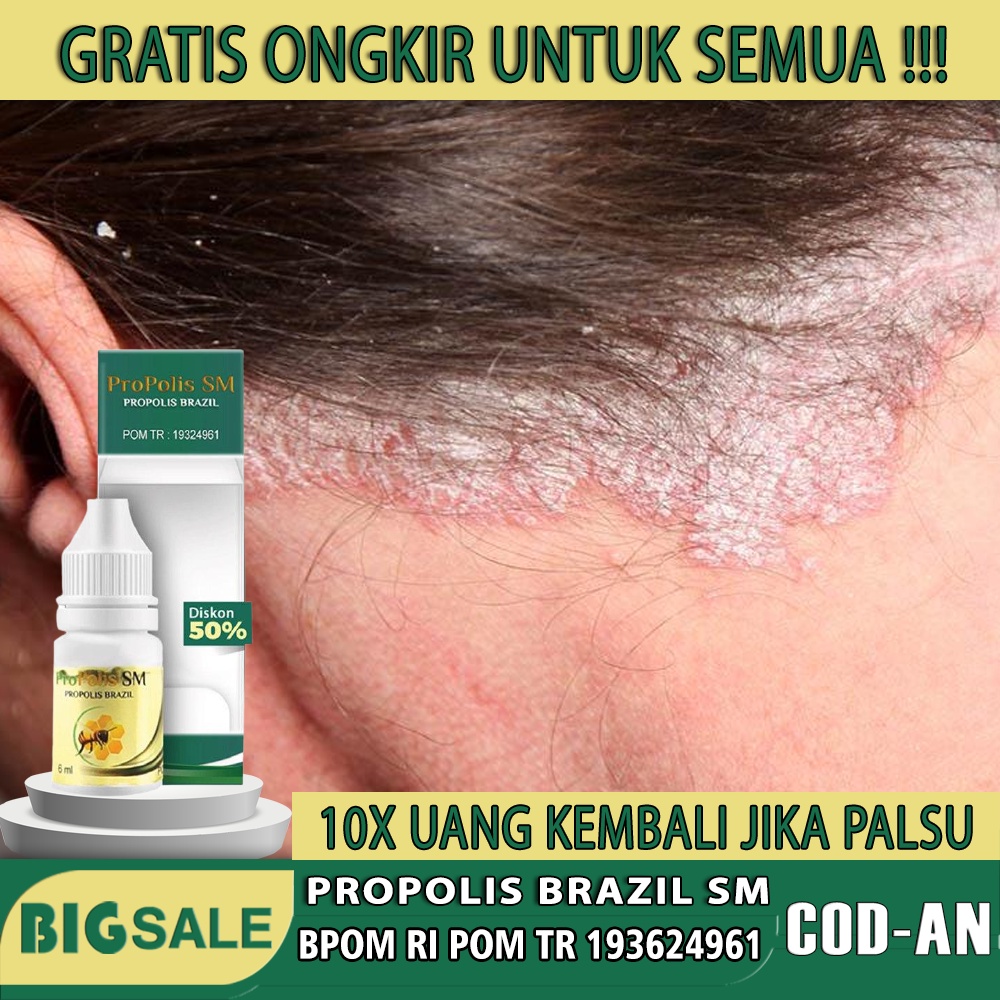 Jual Obat Gatal Kulit Kepala, Ketombe Rambut Kerak, Kulit Kering Bersisik, Koreng Berjamur ...