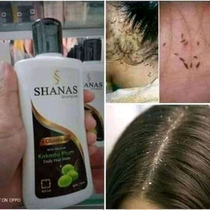 Jual SAMPO SHANAS ANTI KETOMBE DAN PENGHILANG KUTU BY NASA | Shopee Indonesia
