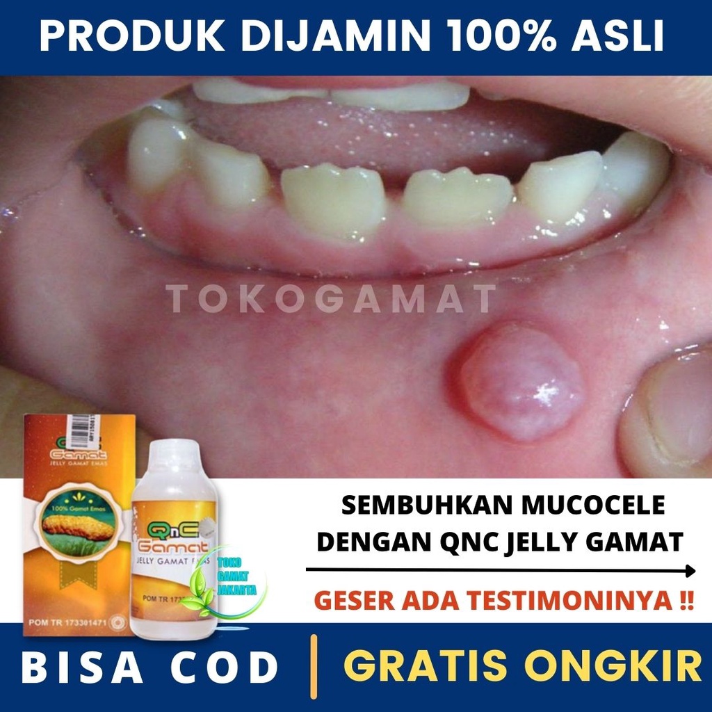 Jual Obat Salep Untuk Mucocele, Mukokel,Kista Di Mulut, Benjolan Di Bibir Bagian Dalam - QNC ...