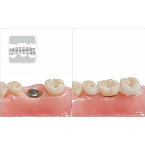 Jual Fiber splinting fiber splint dental | Shopee Indonesia