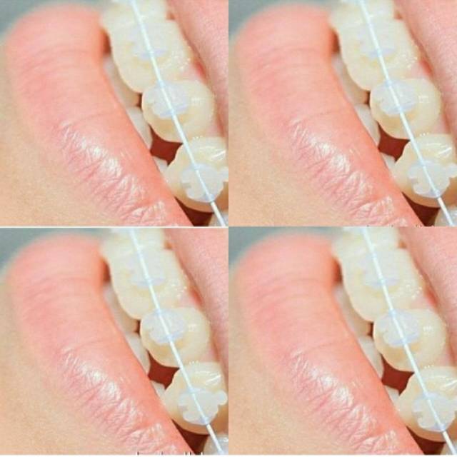 Jual Behel Permanen Ceramik Bening Kawat Putih | Shopee Indonesia