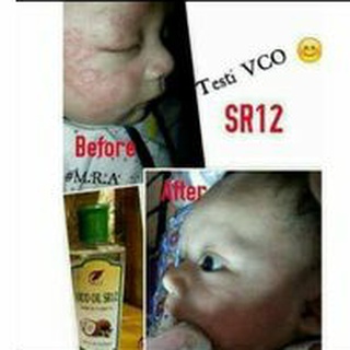 Jual Obat Ruam Popok Bayi / Ruam Pipi / Leher Merah Pada Bayi / Biang ...