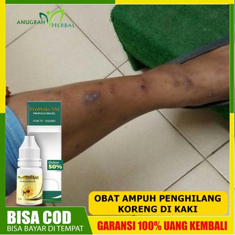 Jual Obat Koreng di Kaki, Obat Bekas Luka Koreng di Kaki, Obat ...