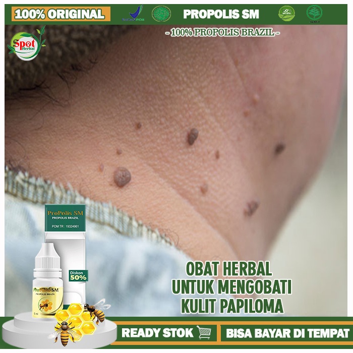 Jual Obat Perontok Papiloma, Obat Penghilang Papiloma di Leher, Obat ...