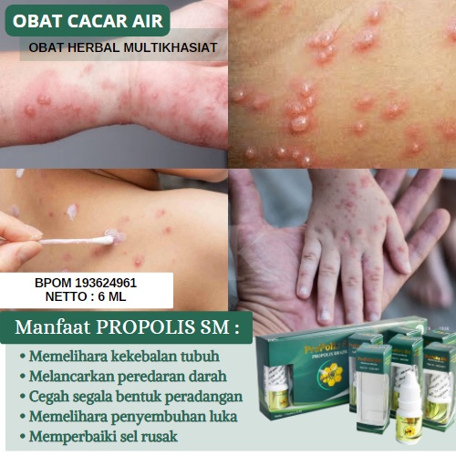 Jual Salep Cacar Air Anak Dan Dewasa, Obat Cacar Monyet, Cacar Ular ...