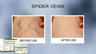 Jual Varicose Veins Treatment Cream Salep Vaskulitis Flebitis Spider ...