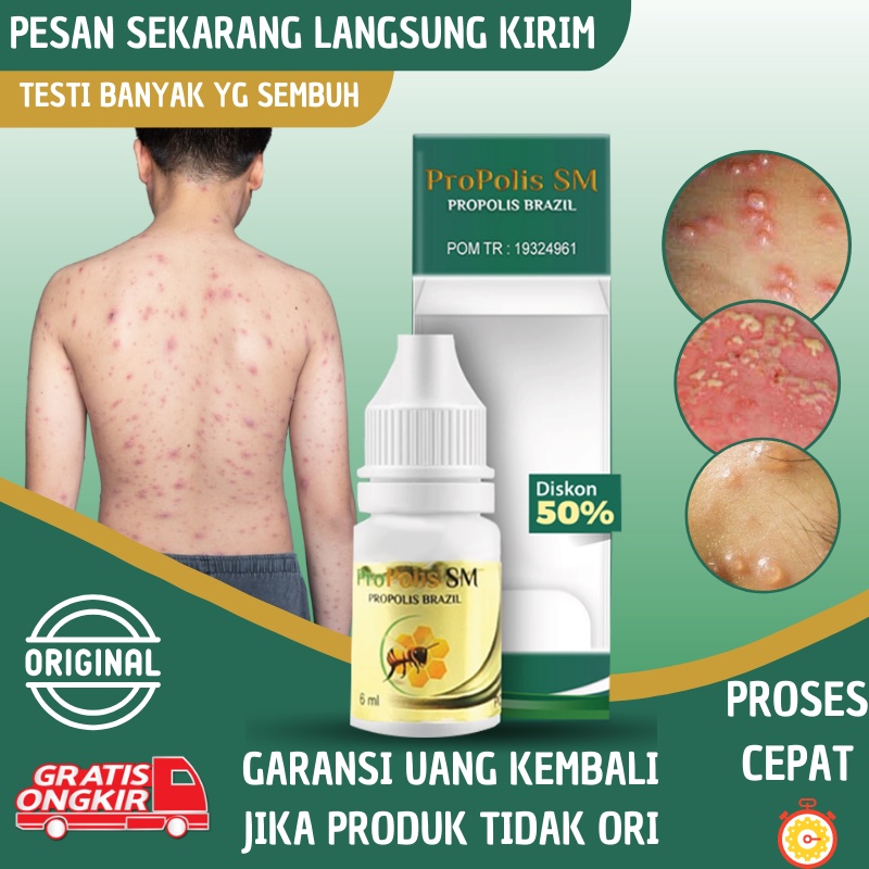 Jual Obat Cacar Air - Obat gatal berair - Obat herpes zoster - Salep ...