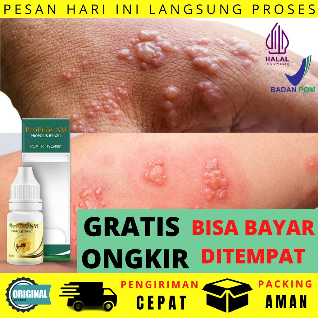 Jual Obat Cacar Monyet Ular Nyeri Kepala Berat Herbal Luka Air Berair ...