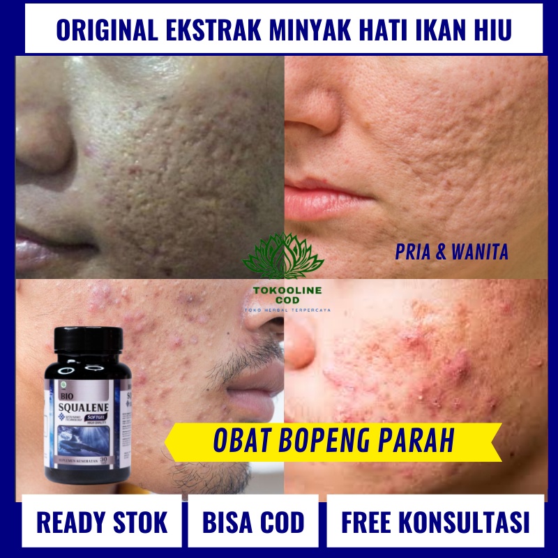 Jual Obat Bopeng Parah - Penghilang Bekas Jerawat Pria, Obat Bopeng ...