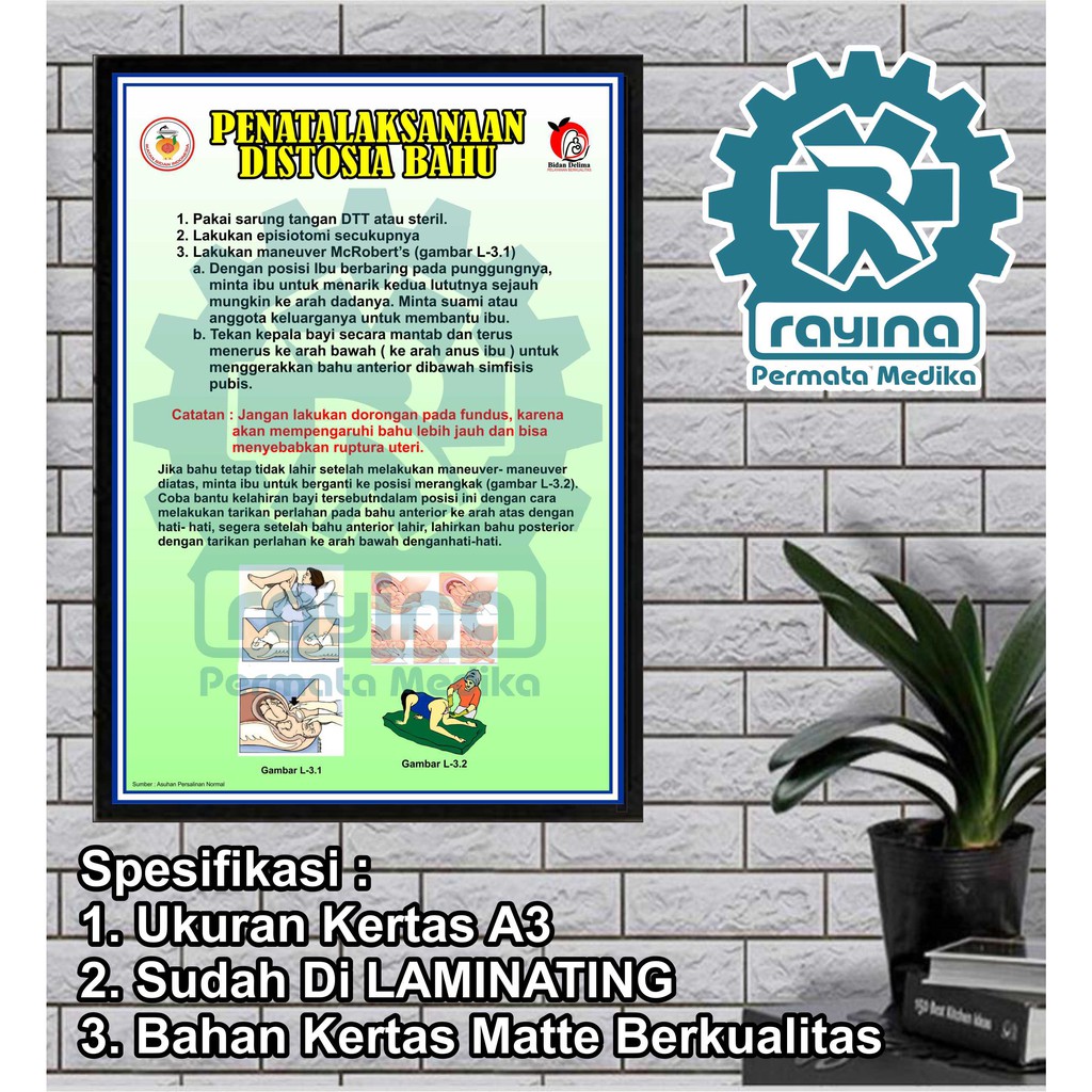 Jual Poster Penatalaksanaan Distosia Bahu | Shopee Indonesia
