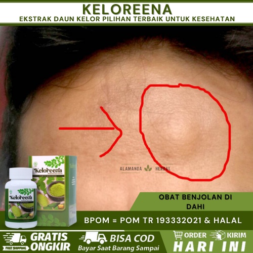 Jual Obat Benjolan Di Dahi, Benjolan Di Jidat, Benjolan Di Kening, Di ...