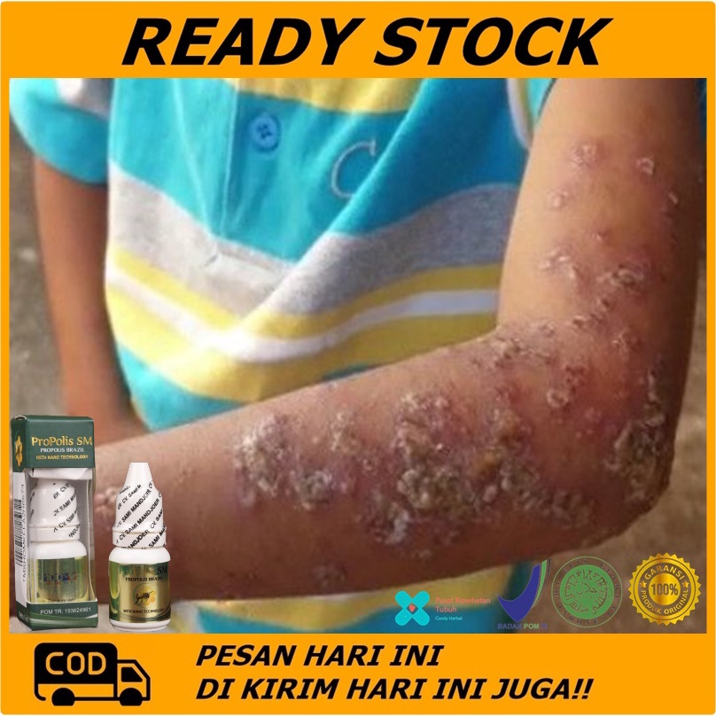 Jual Obat budug di tangan, Obat Oles Budug Alami, Salep Budug Bernanah ...