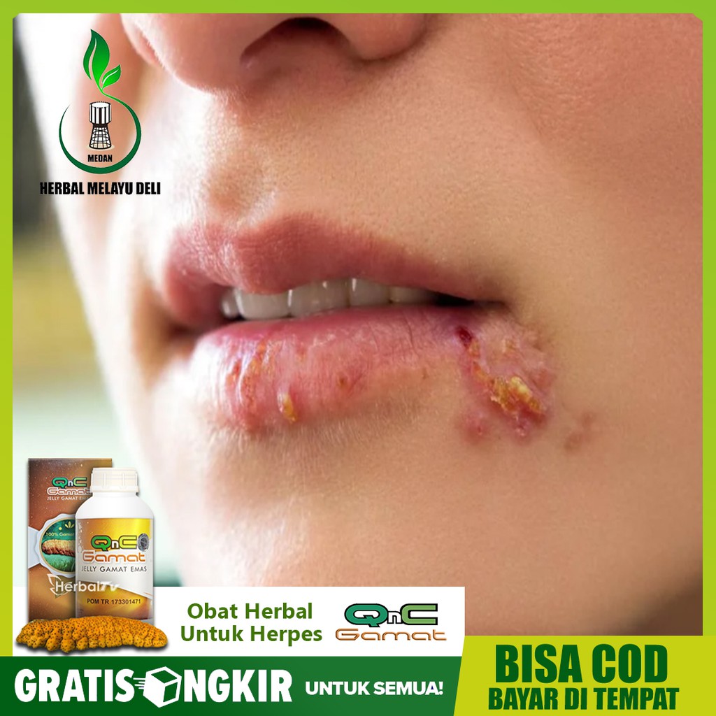 Jual Obat herpes, gatal gatal, sariawan, sakit saat menelan, luka lepuh ...