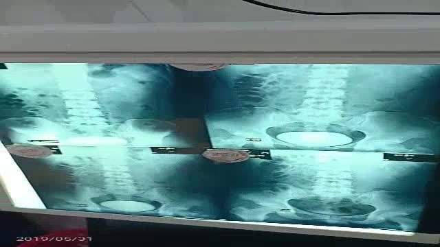 Jual Lampu Baca Foto Ronsen SSM X-RAY Rontgen Radiologi hasil ronsen ...