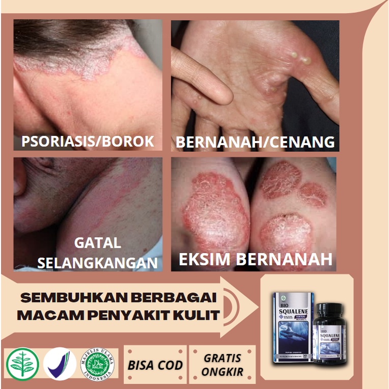 Jual Obat Penghilang Borok Menahun Psoriasis Di Kepala Kaki Tangan Bernanah Alergi Kulit ...