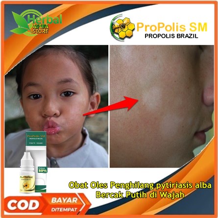 Jual Obat Oles Penghilang Pytiriasis Alba Bercak Putih di Wajah, Herbal ...