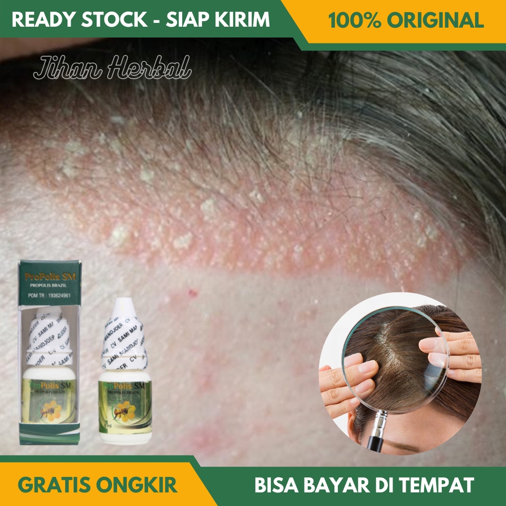 Jual Obat Kulit Kepala Kering, Obat Kulit Kepala Gatal, Obat Kulit Kepala Berkerak, Obat Ketombe ...