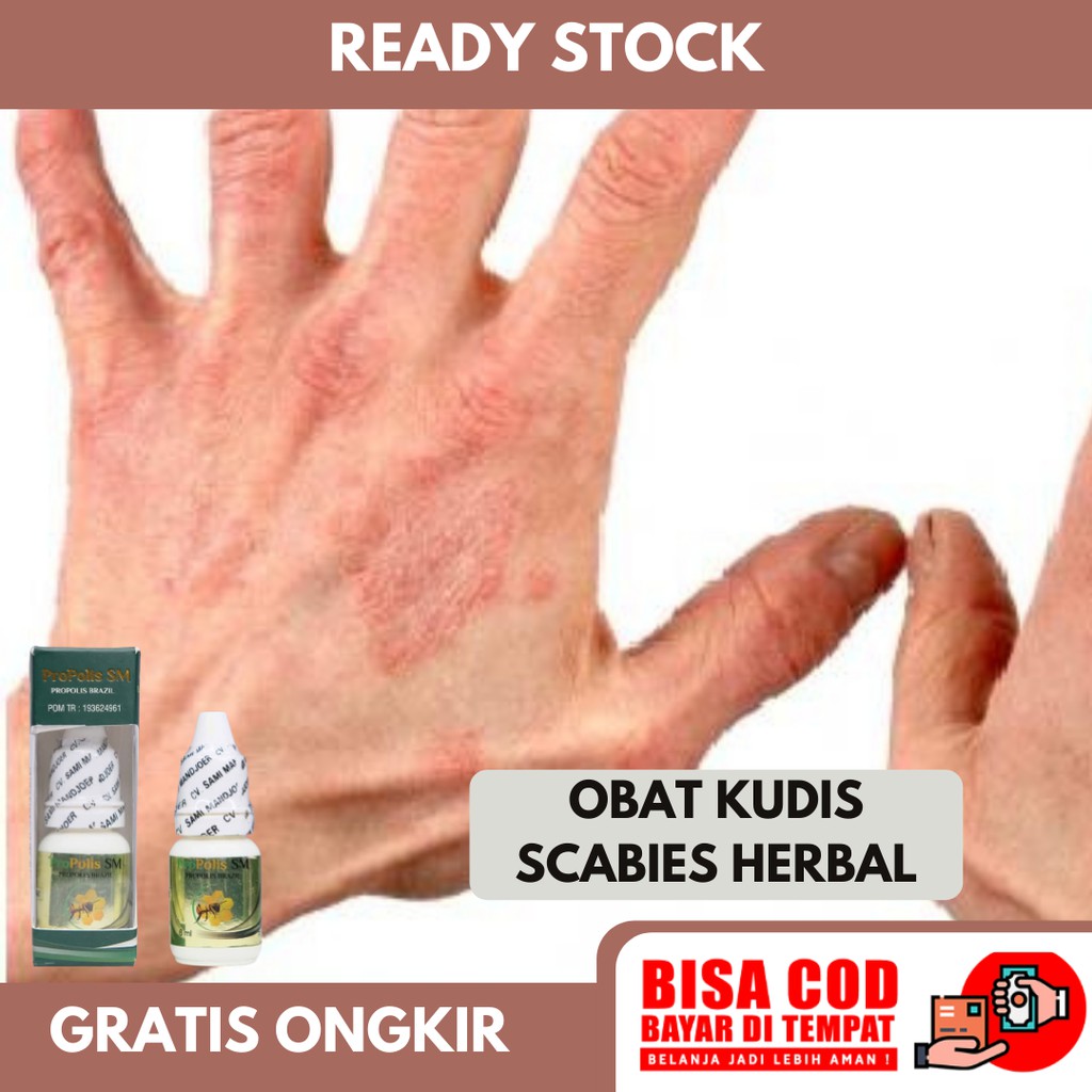 Jual Obat Scabies, Kudis, Bintik Berair dan Gatal, Eksim, Koreng, Luka ...