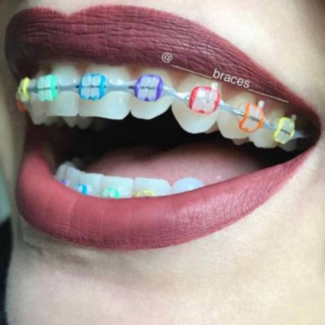 Paket Behel Ceramic Transparan | Shopee Indonesia