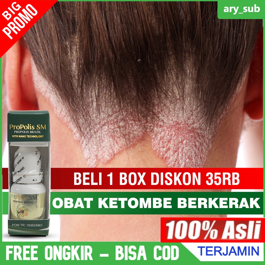 Jual Obat ketombe Berkerak, Borok, Akut, Ketombe Rambut, Ketombe Kulit Kepala Kering Propolis SM ...