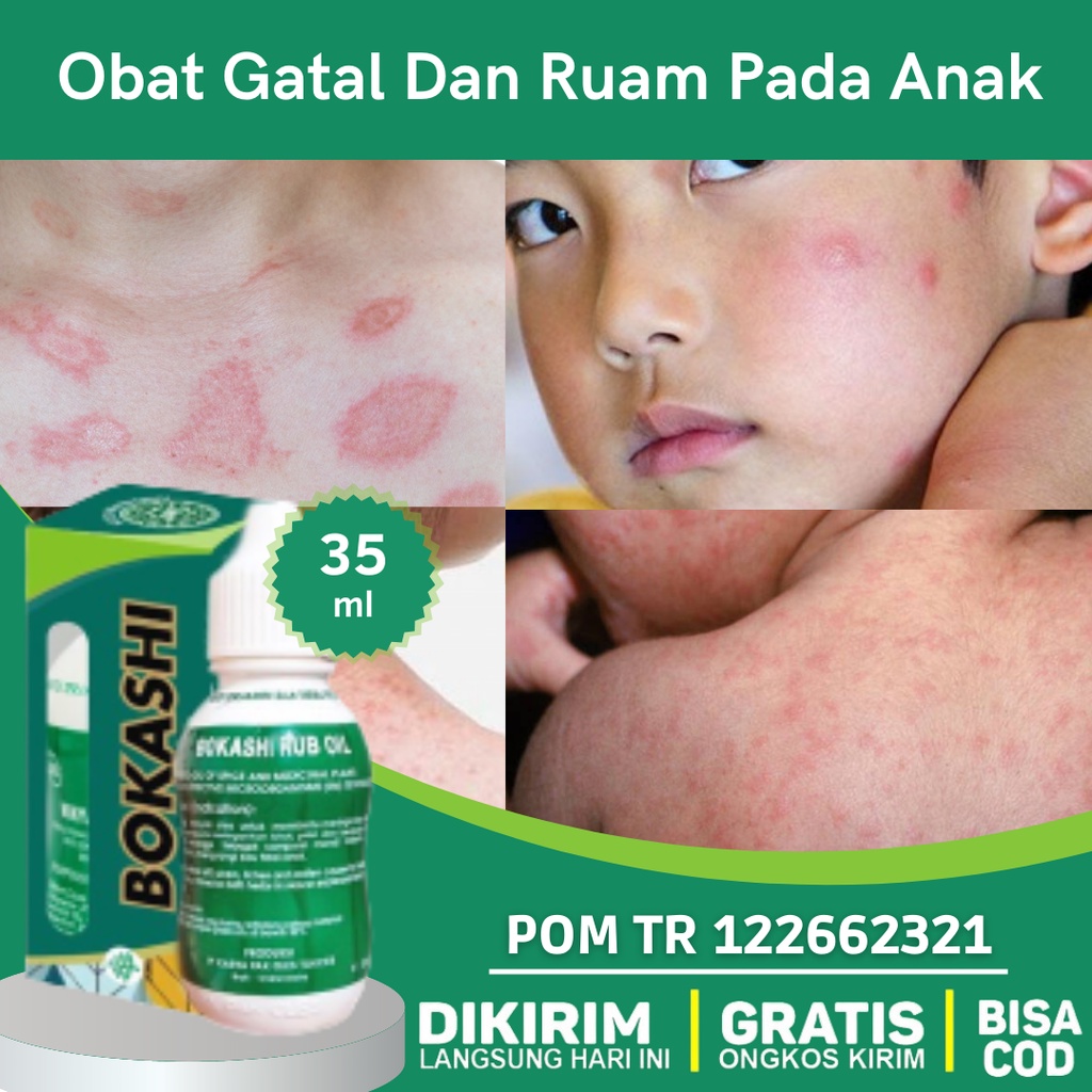 Jual Obat Gatal Ruam Kulit Merah Untuk Anak Anak dan Balita Sudah BPOM ...