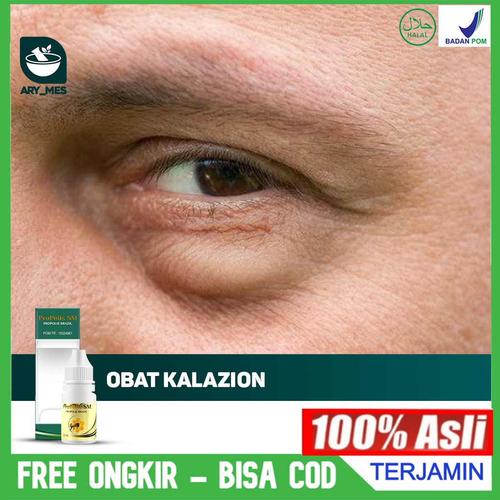 Jual Obat Kalazion - Benjolan Kelopak Mata Bengkak - Sakit Mata ...