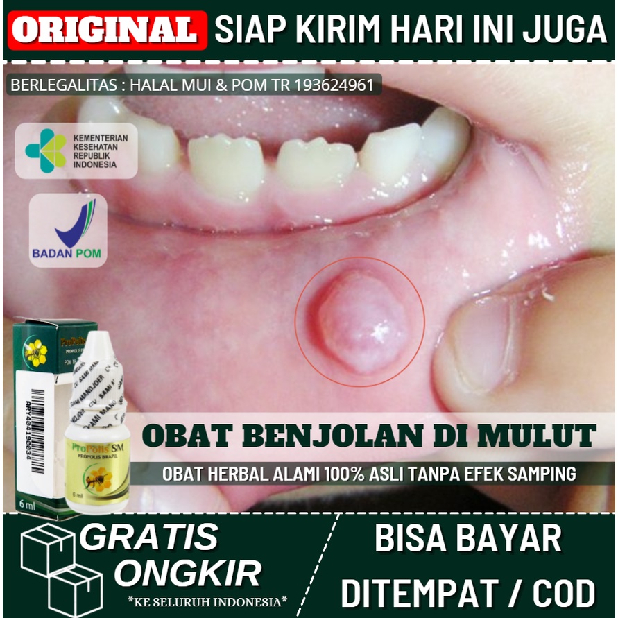 Jual Obat Herbal Pengempis Benjolan di Mulut & Lidah 100% ALAMI, Obat ...