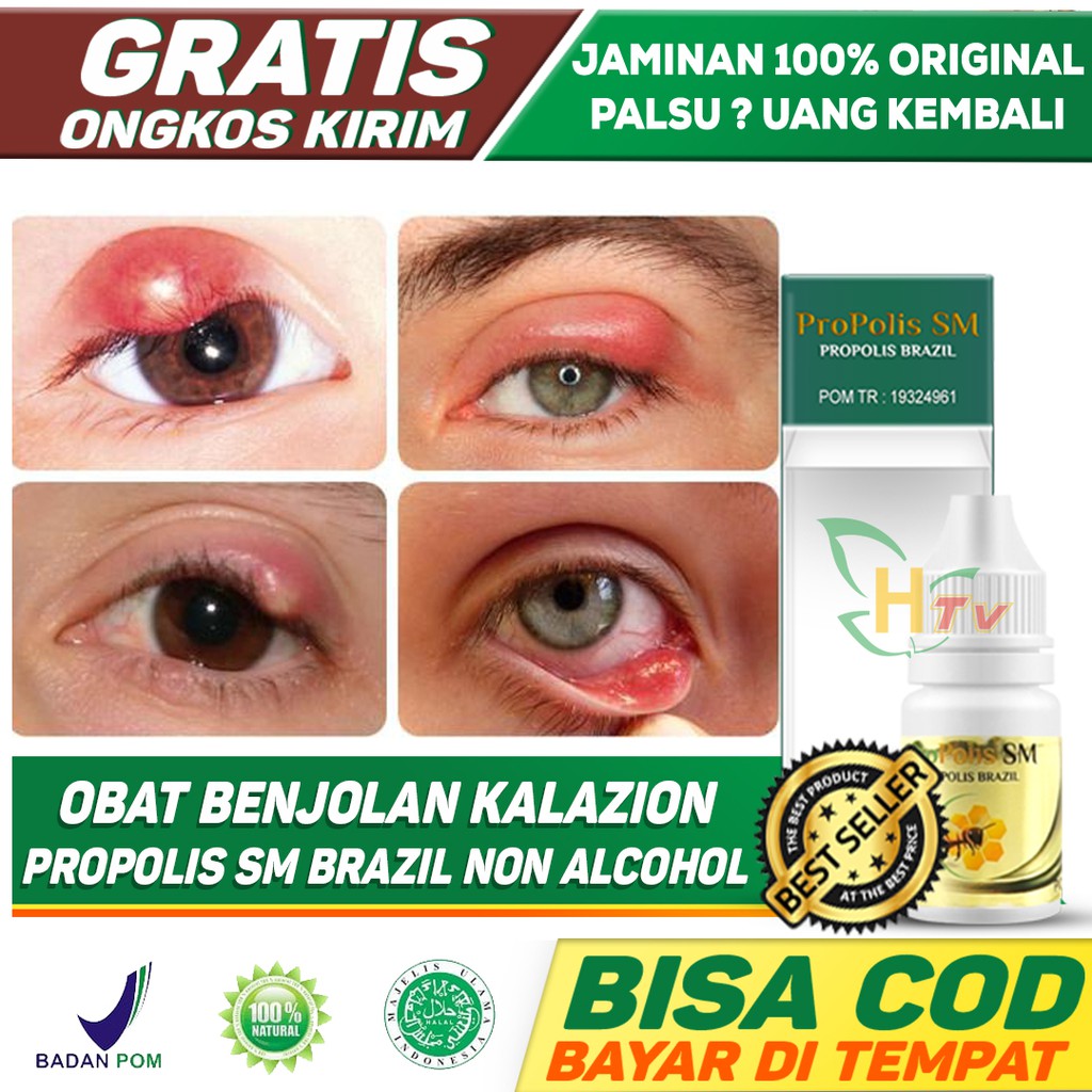 Jual Obat Bintitan - Kalazion - Benjolan Di Kelopak Mata - Benjolan Di ...