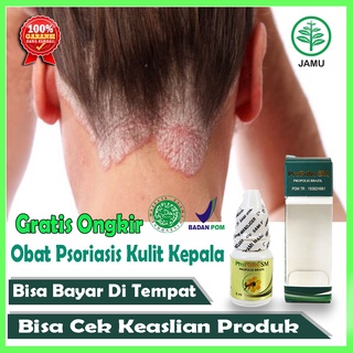 Jual Obat Salep/Oles Psoriasis Kulit Kepala Kering Berkerak Bersisik Jamur Bersisik Ketombe ...